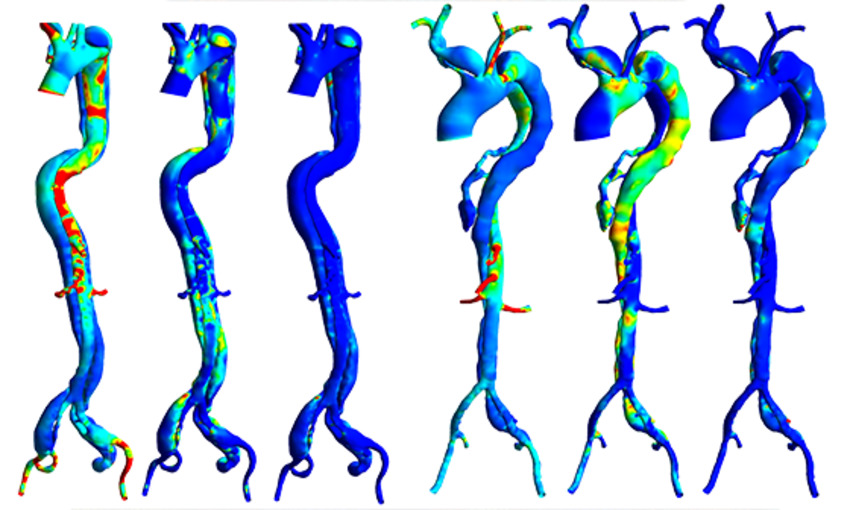 Patient-Specific Hemodynamic Simulations | Synopsys Simpleware