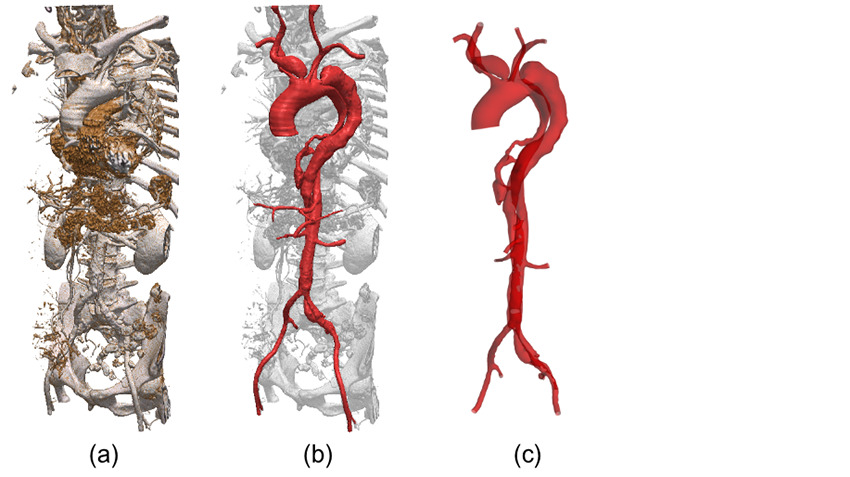 Patient-Specific Hemodynamic Simulations | Synopsys Simpleware