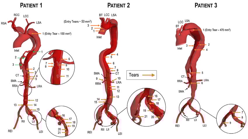 Patient-Specific Hemodynamic Simulations | Synopsys Simpleware