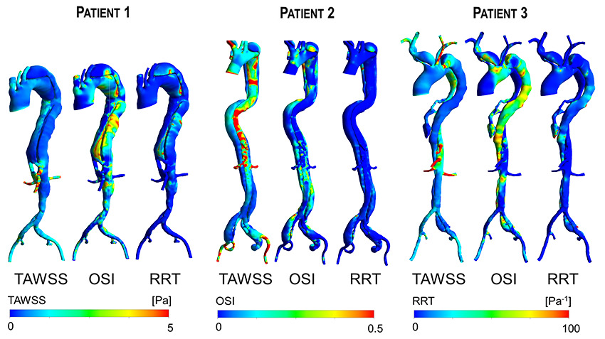 Patient Specific Hemodynamic Simulations Synopsys Simpleware
