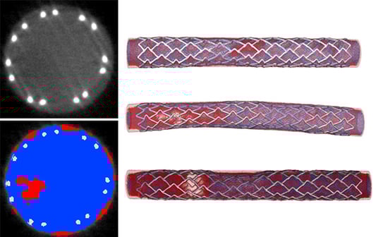 Medical Image Analysis of Thrombosis Formation in Malapposed Coronary ...