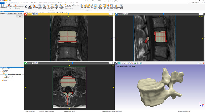 Apr 30, 2020: Orthopedic Image Segmentation in Simpleware Software