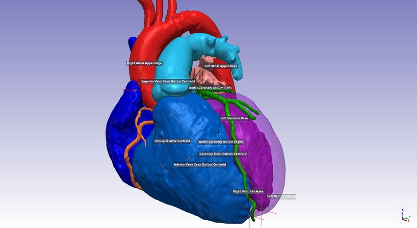 AI-Enabled Heart Segmentation and Landmarking with Simplware | Synopsys