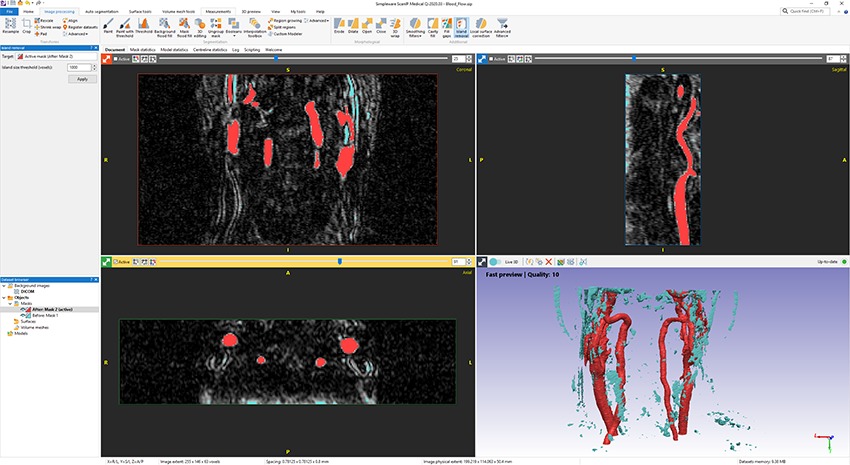 Top tips to Speed up Cardiovascular Image Segmentation in Simpleware ...
