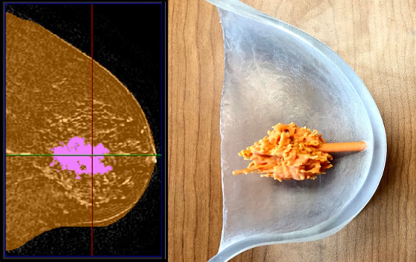 Segmentation & Modeling of Breast Tumor for 3D Printing with Simpleware ...