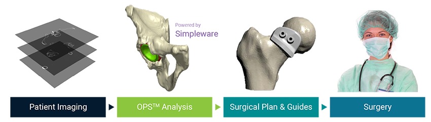Simpleware Case Study: Streamlining Orthopedic Surgical Planning with Corin