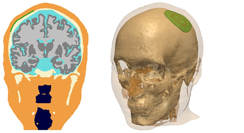 Epicranial Cortical Stimulation with Simpleware | Synopsys