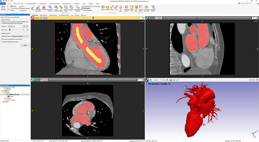 Top tips to Speed up Cardiovascular Image Segmentation in Simpleware ...