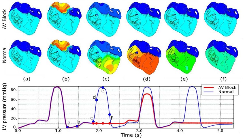 Using Digital Twins to Investigate Atrioventricular Block | Synopsys ...