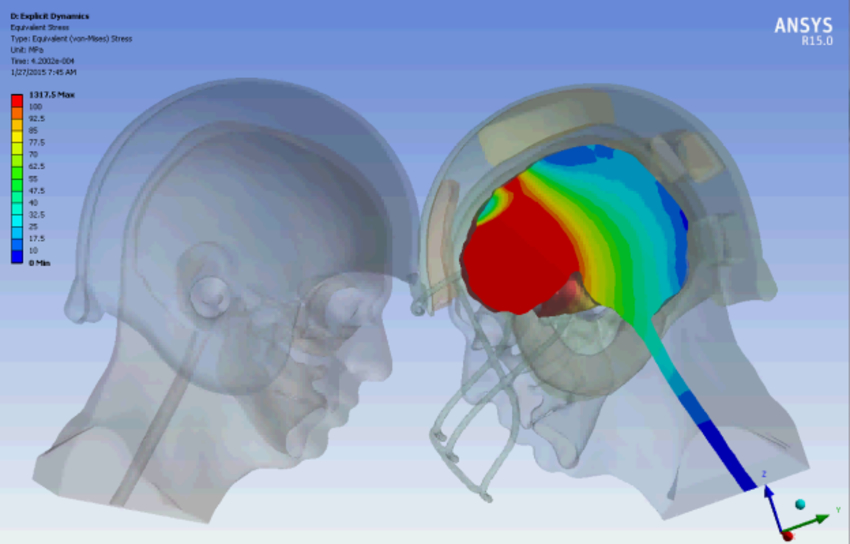 Simpleware working with ANSYS on Simulating Head Injuries in American ...