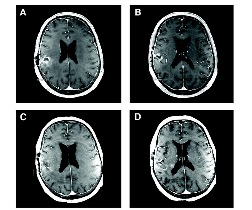 Modeling Alternating Electric Fields for Brain Tumor Treatment ...