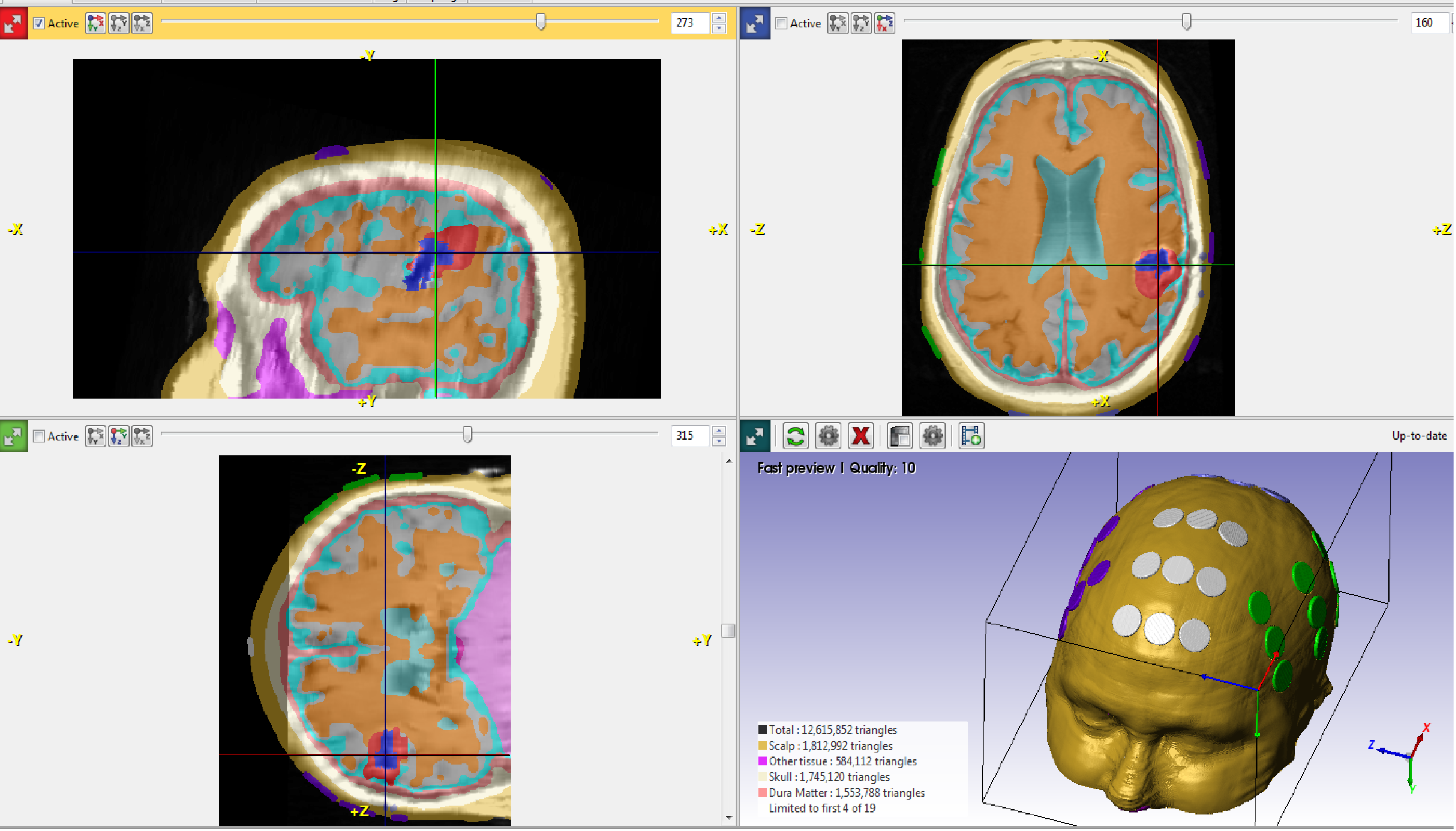 Modeling Alternating Electric Fields for Brain Tumor Treatment ...