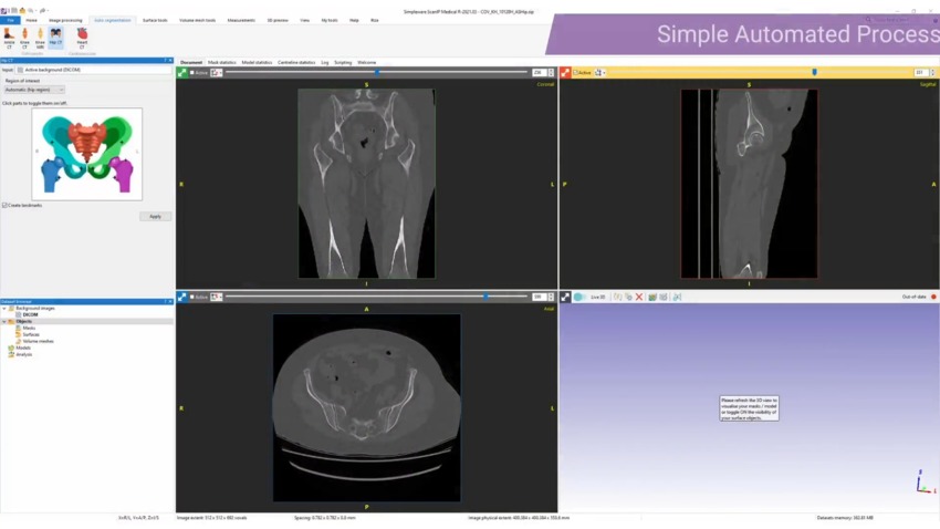 Simpleware for Point-of-Care (POC) 3D Printing | Synopsys